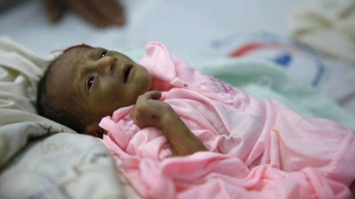 Desnutrición en Bolivia: tiene 13 años y pesa sólo 10 kilos